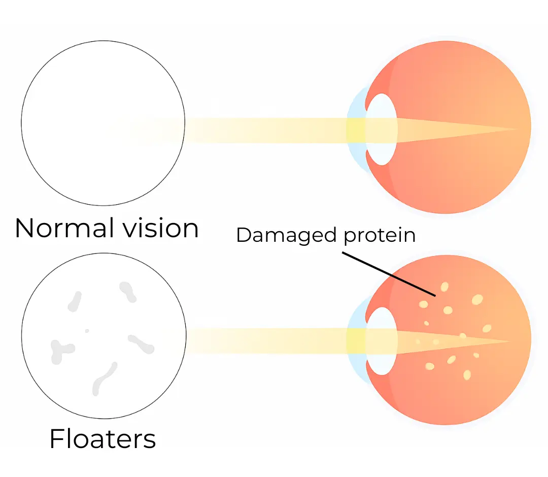 4k Vision | Premium Eye Floater Support